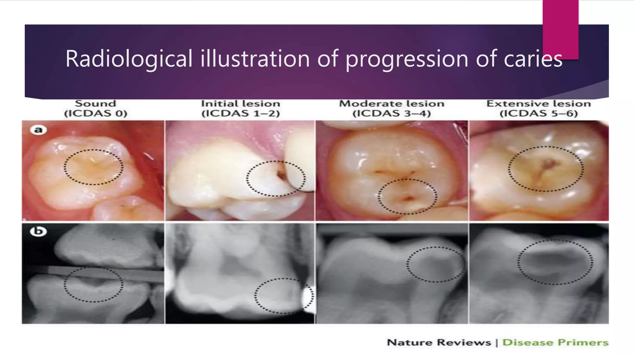 Progression oEnamel caries | PPTX | Dental Health | Diseases and Conditions
