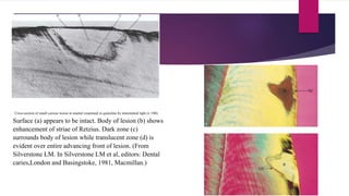 Progression oEnamel caries | PPTX | Dental Health | Diseases and Conditions