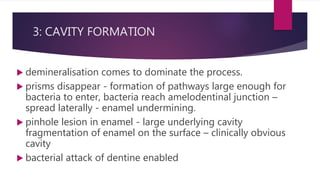 Progression oEnamel caries | PPTX