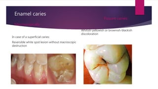 Progression oEnamel caries | PPTX
