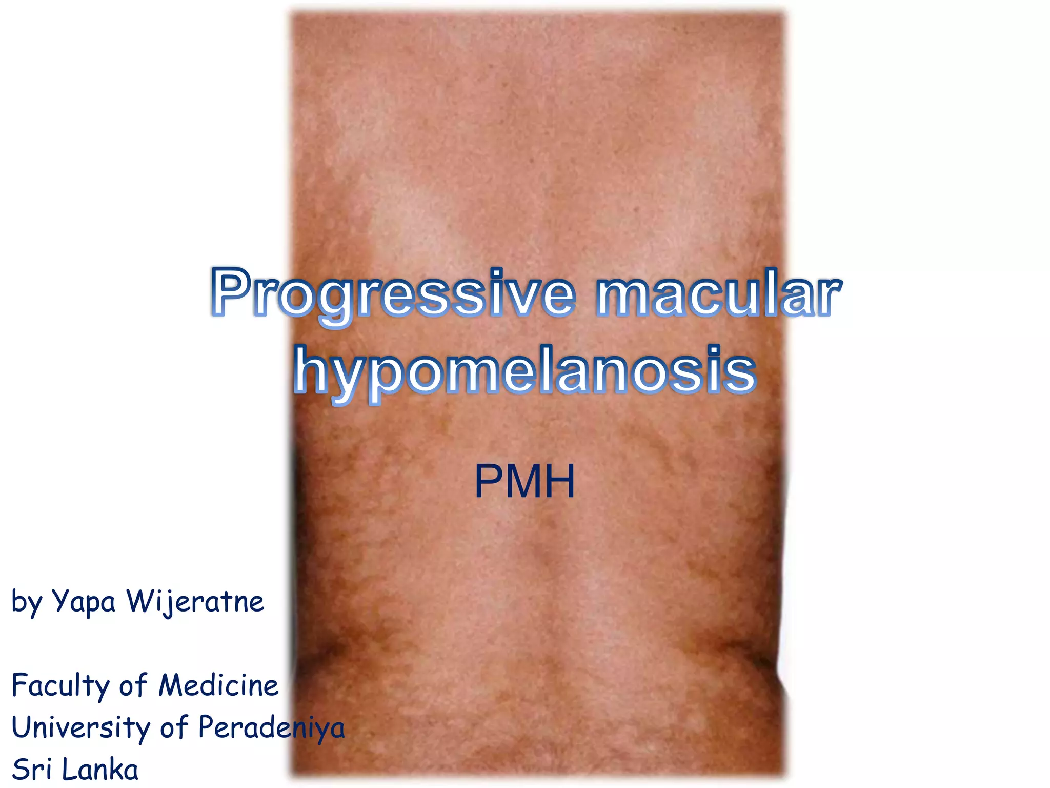 Progressive macular hypomelanosis PMH | PPT