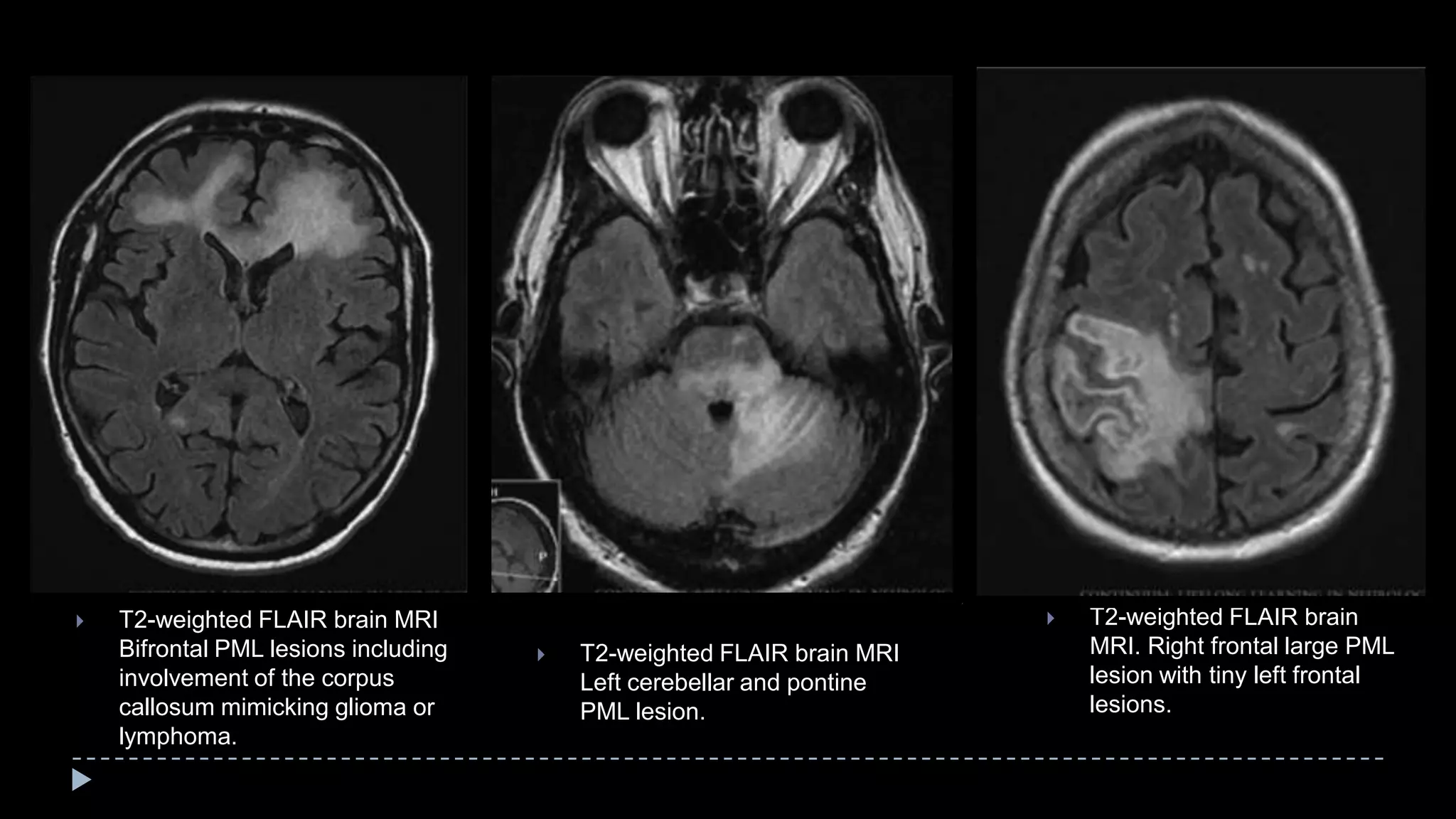 Progressive multifocal leukoencephalopathy | PPTX