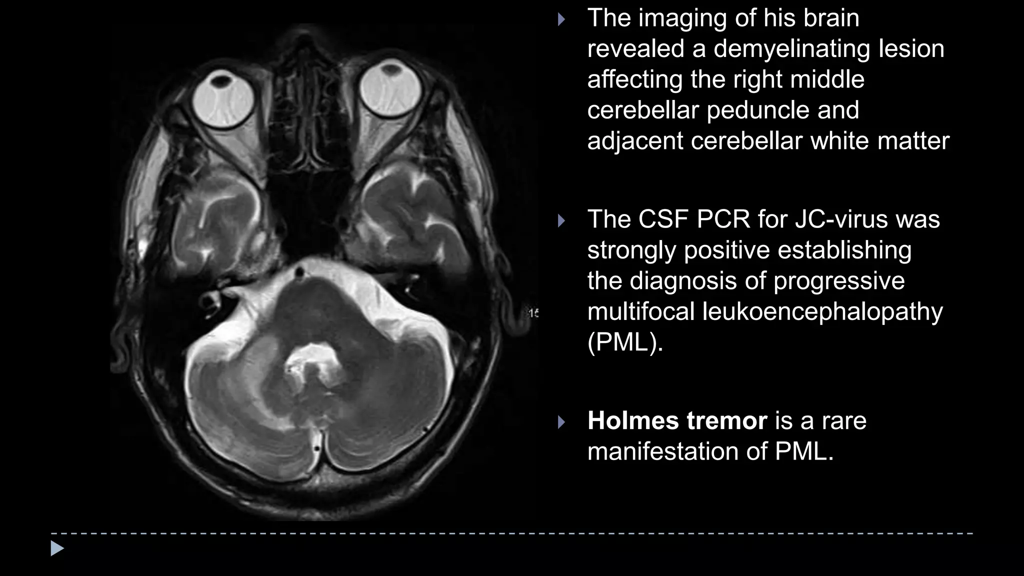 Progressive multifocal leukoencephalopathy | PPTX