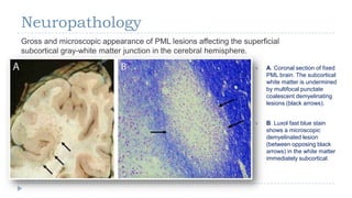 Progressive multifocal leukoencephalopathy | PPTX