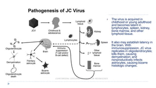 Progressive Multifocal Leukoencephalopathy Gross