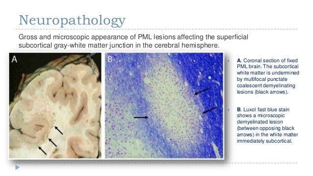 Progressive multifocal leukoencephalopathy