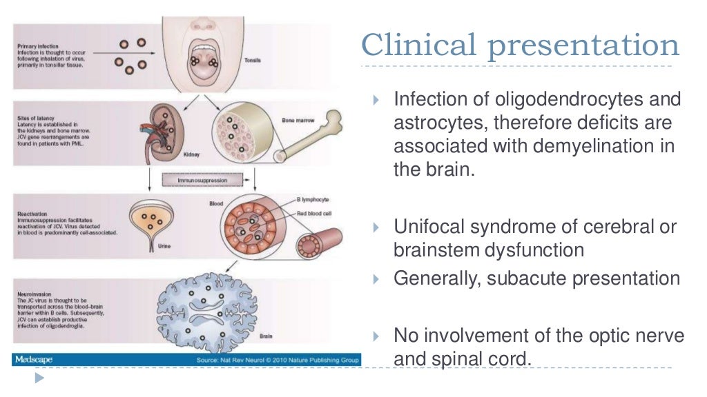 Progressive multifocal leukoencephalopathy