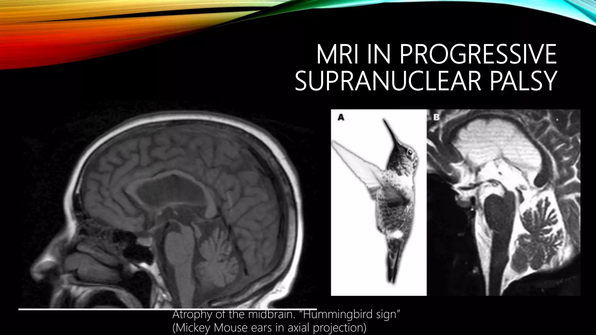 Progressive supranuclear palsy richardson syndrome 060419 | PPTX