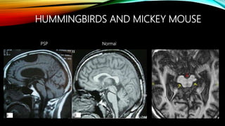 Progressive supranuclear palsy richardson syndrome 060419 | PPTX