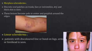 Progressive systemic sclerosis | PPT