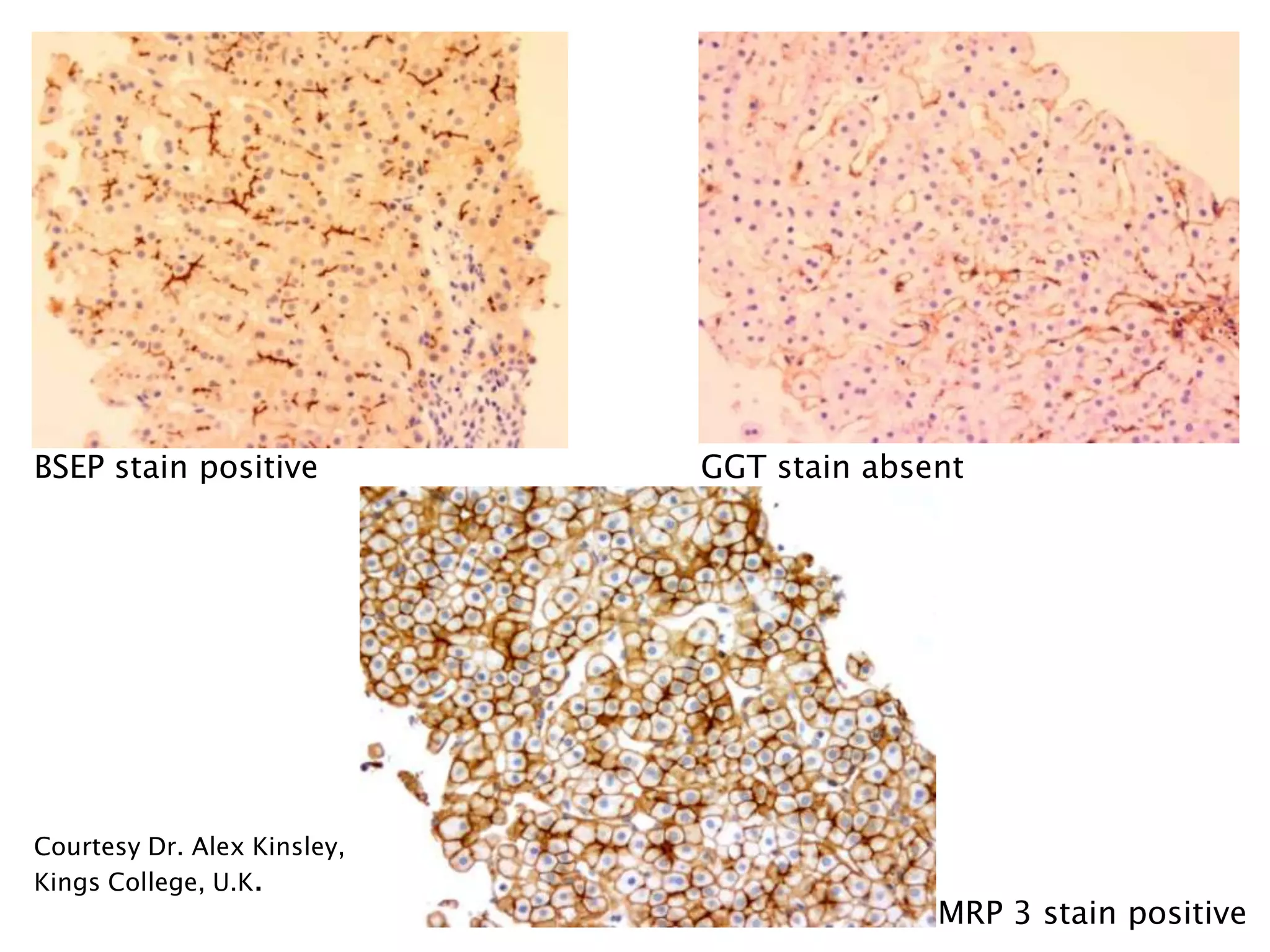 Progressiv familial intrahepatic cholestasis type 1 case presentation ...