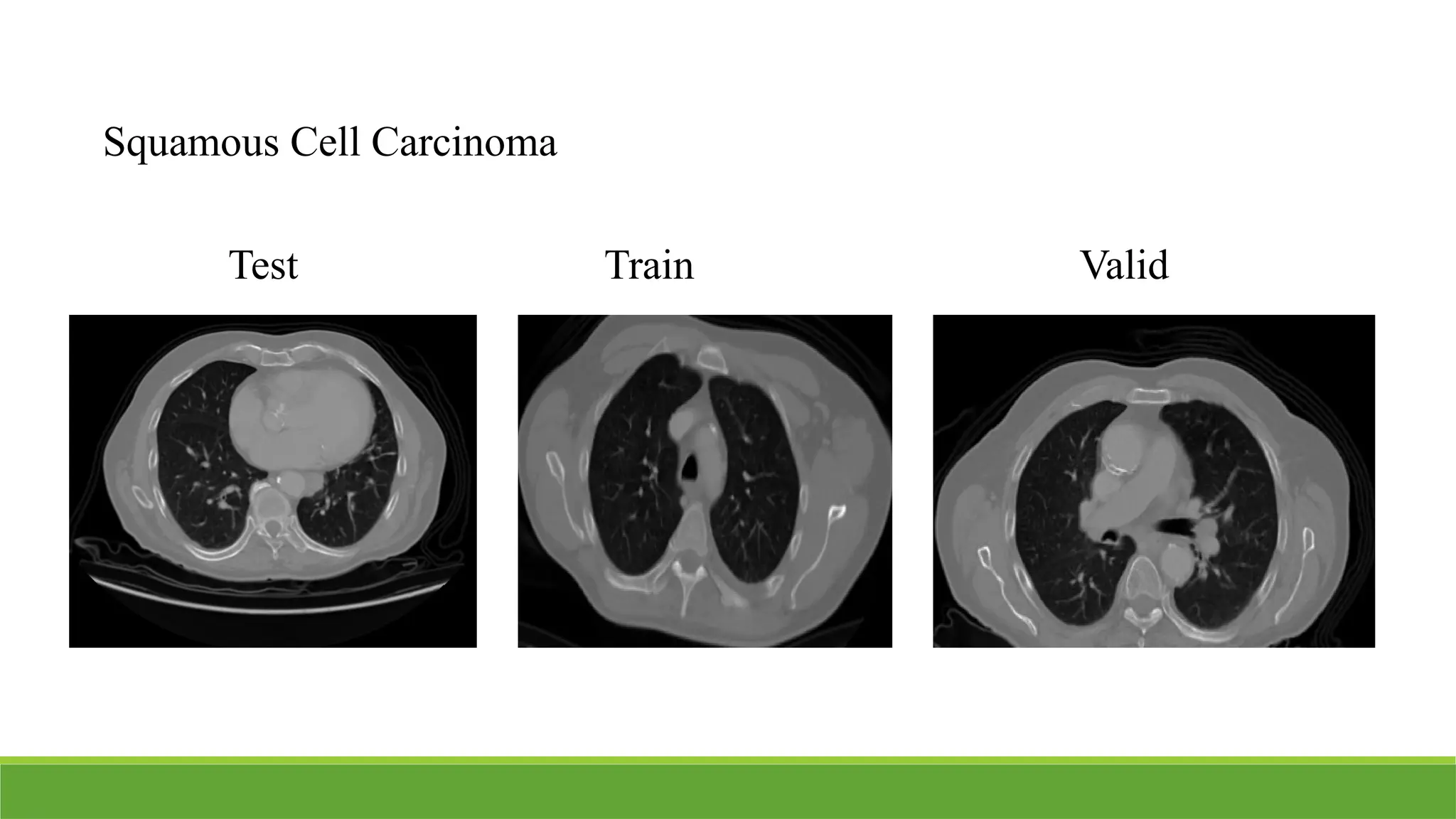 Detection Of Lung Cancer From Ct Images Using Svm Classification And