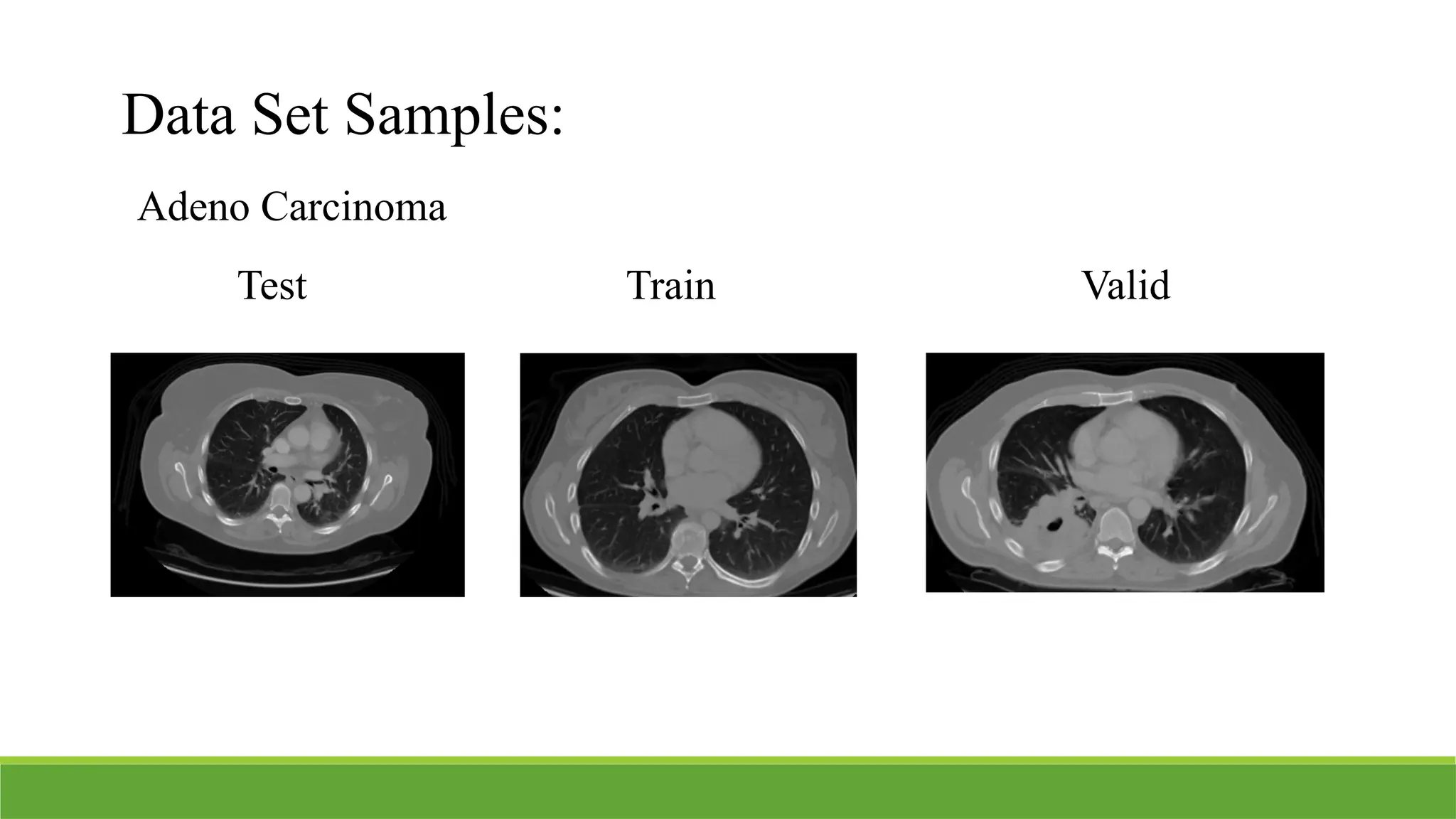 Detection Of Lung Cancer From Ct Images Using Svm Classification And Compare The Survival Rate
