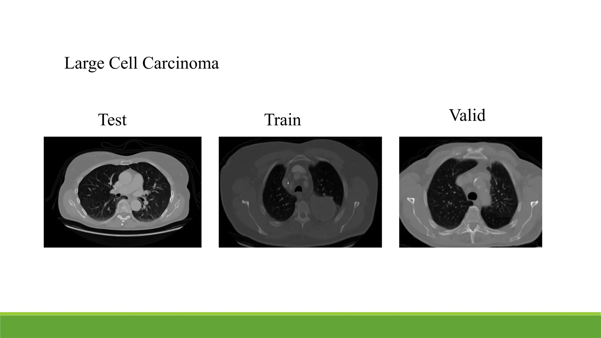 Detection Of Lung Cancer From Ct Images Using Svm Classification And