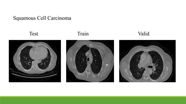 Detection Of Lung Cancer From Ct Images Using Svm Classification And Compare The Survival Rate