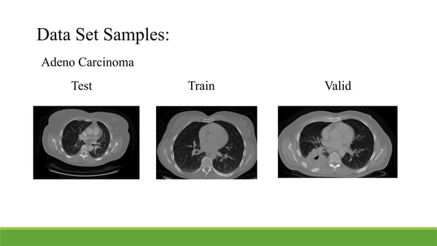Detection Of Lung Cancer From Ct Images Using Svm Classification And Compare The Survival Rate