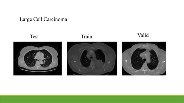 Detection of Lung Cancer from CT images using SVM Classification and ...
