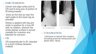 PROJECTION OF ANKLE(KARSANG FENGTE)-1.pdf