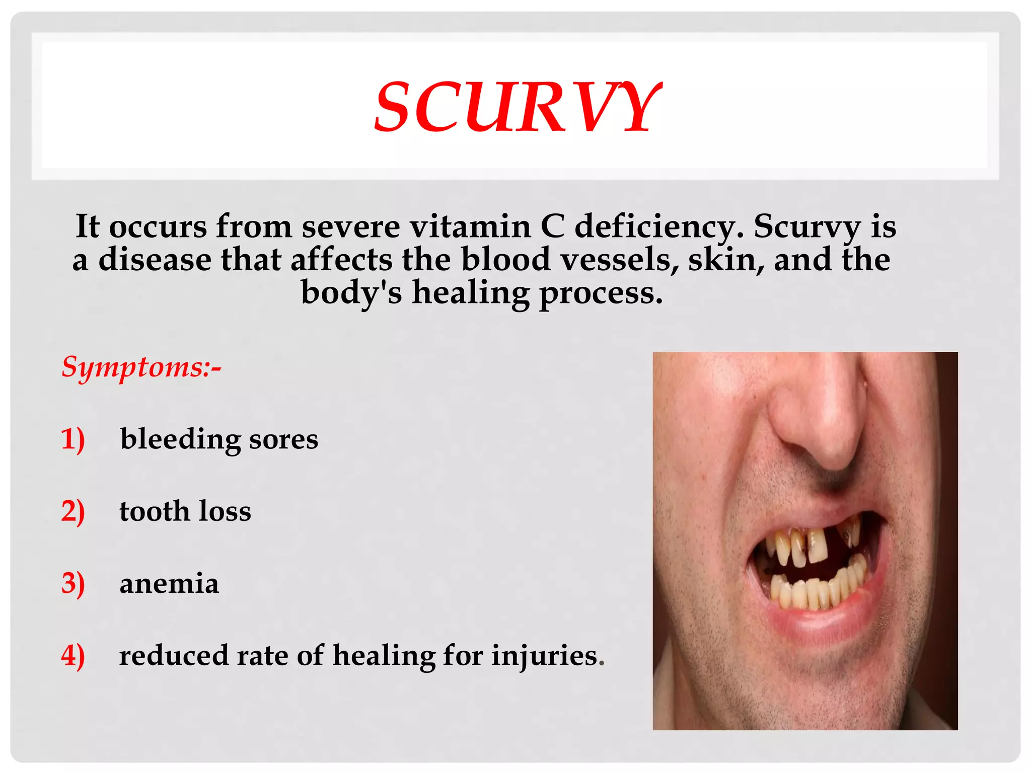 Project on deficiency diseases by naisha beri, class-5 a | PDF