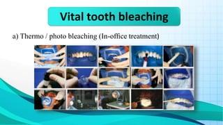 dental bleaching | PPTX