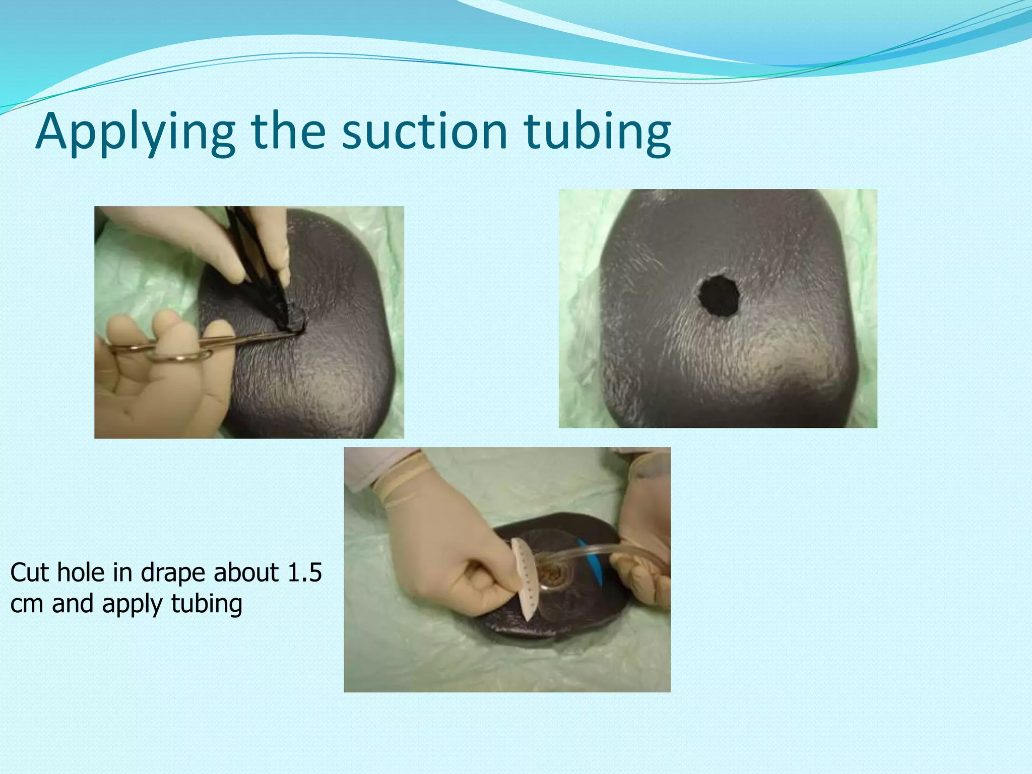 VACUUM ASSISTED WOUND THERAPY | PPTX