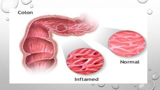 Rektokoliti Ulceroz,Kanceri Kolorektal, Obstruksioni Akut i Kolonit | PPT