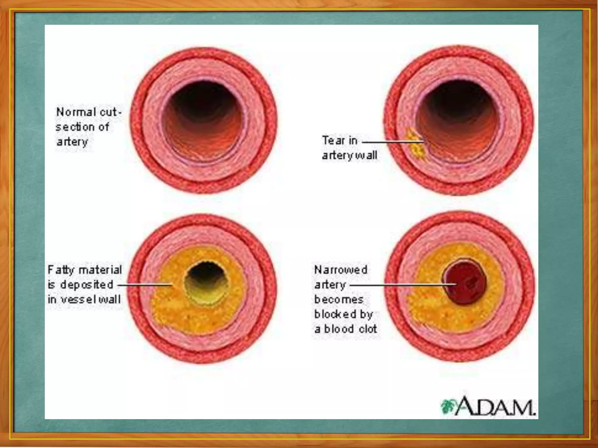 PROLANIS_STROKE.pptx