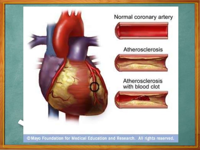 PROLANIS_STROKE.pptx