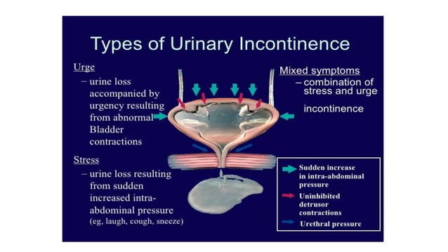 uterine Prolapse and incontinence | PPTX
