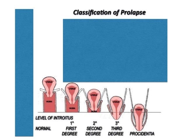 Uterine Prolapse Grading