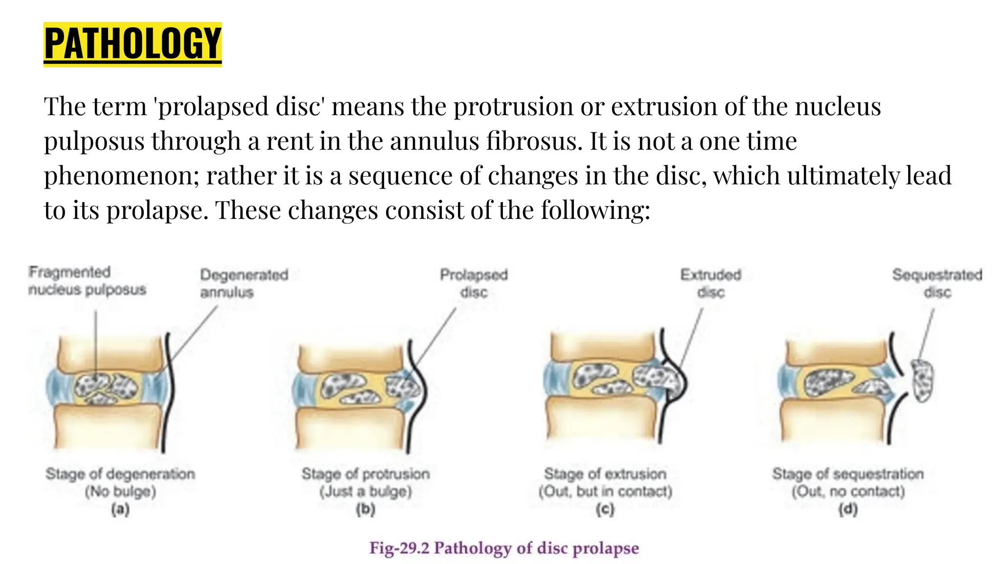 Prolapsed-Intervertebral-Disc presentation.pdf