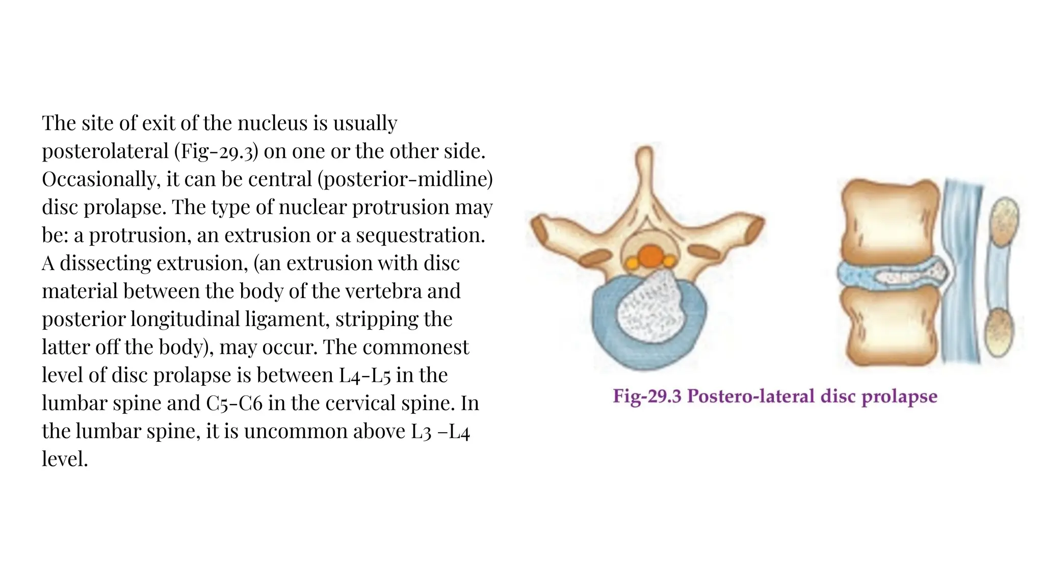 Prolapsed-Intervertebral-Disc presentation.pdf