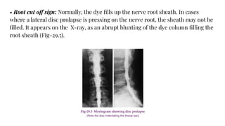 Prolapsed-Intervertebral-Disc presentation.pdf