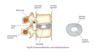 Prolapsed-Intervertebral-Disc presentation.pdf