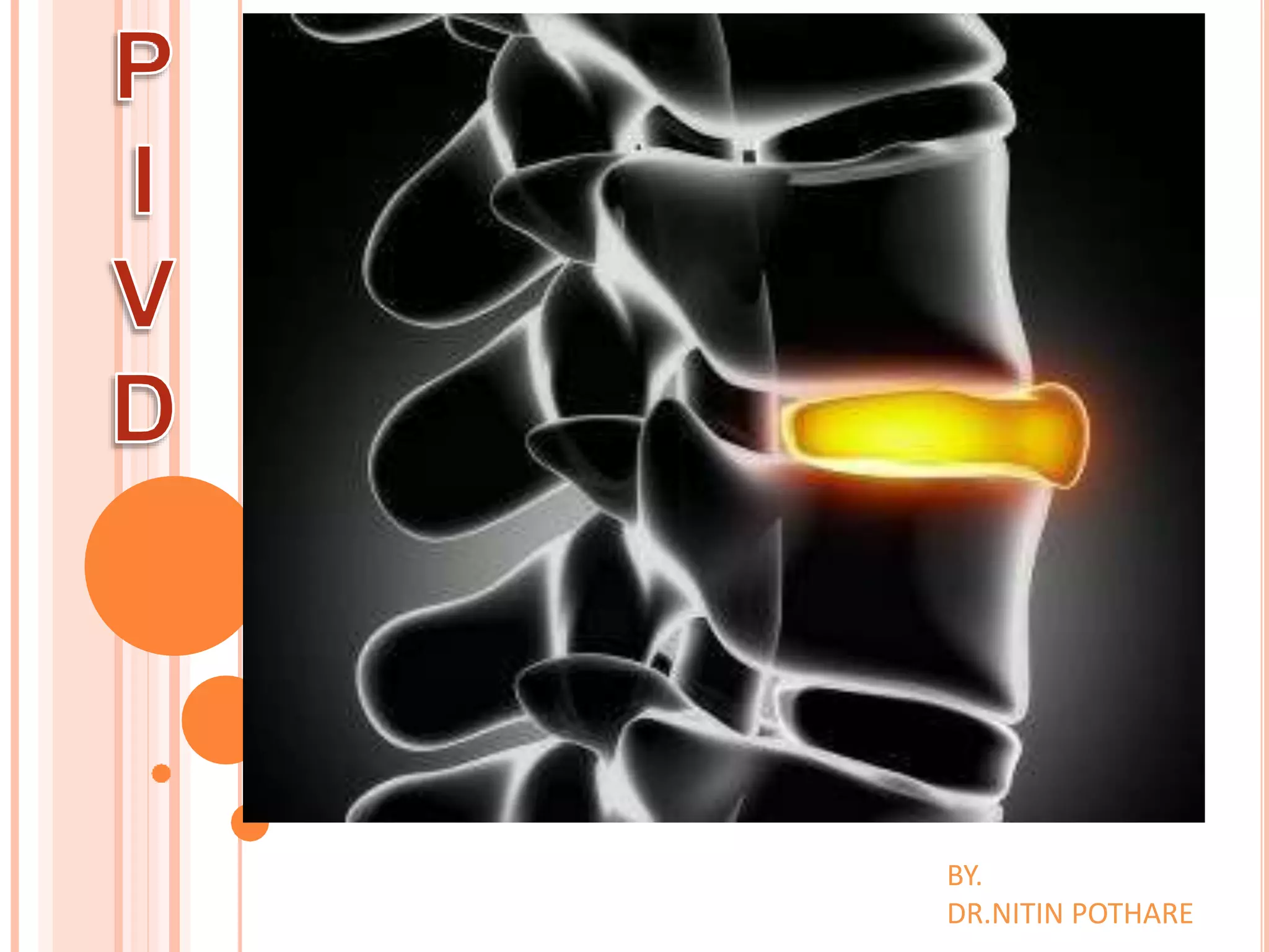 Prolapsed intervertebral disc | PPTX