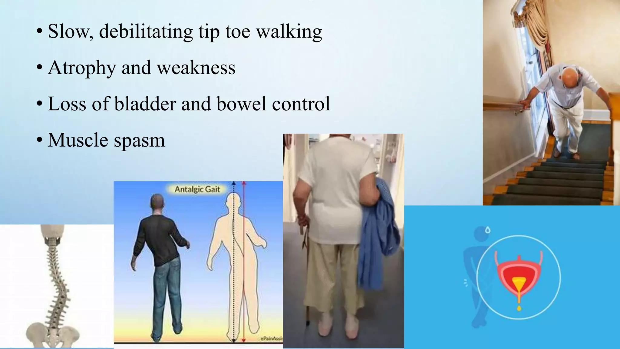 Prolapsed intervertebral disc ppt slideshare | PPTX