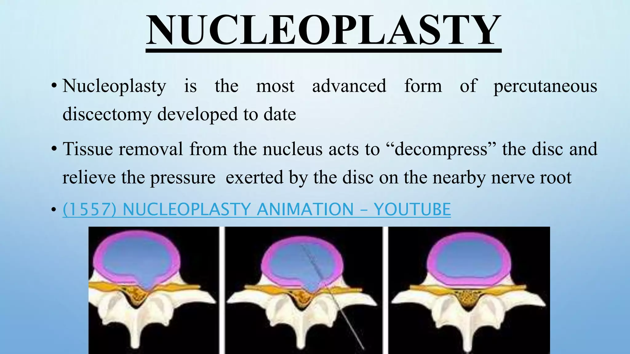 Prolapsed intervertebral disc ppt slideshare | PPTX