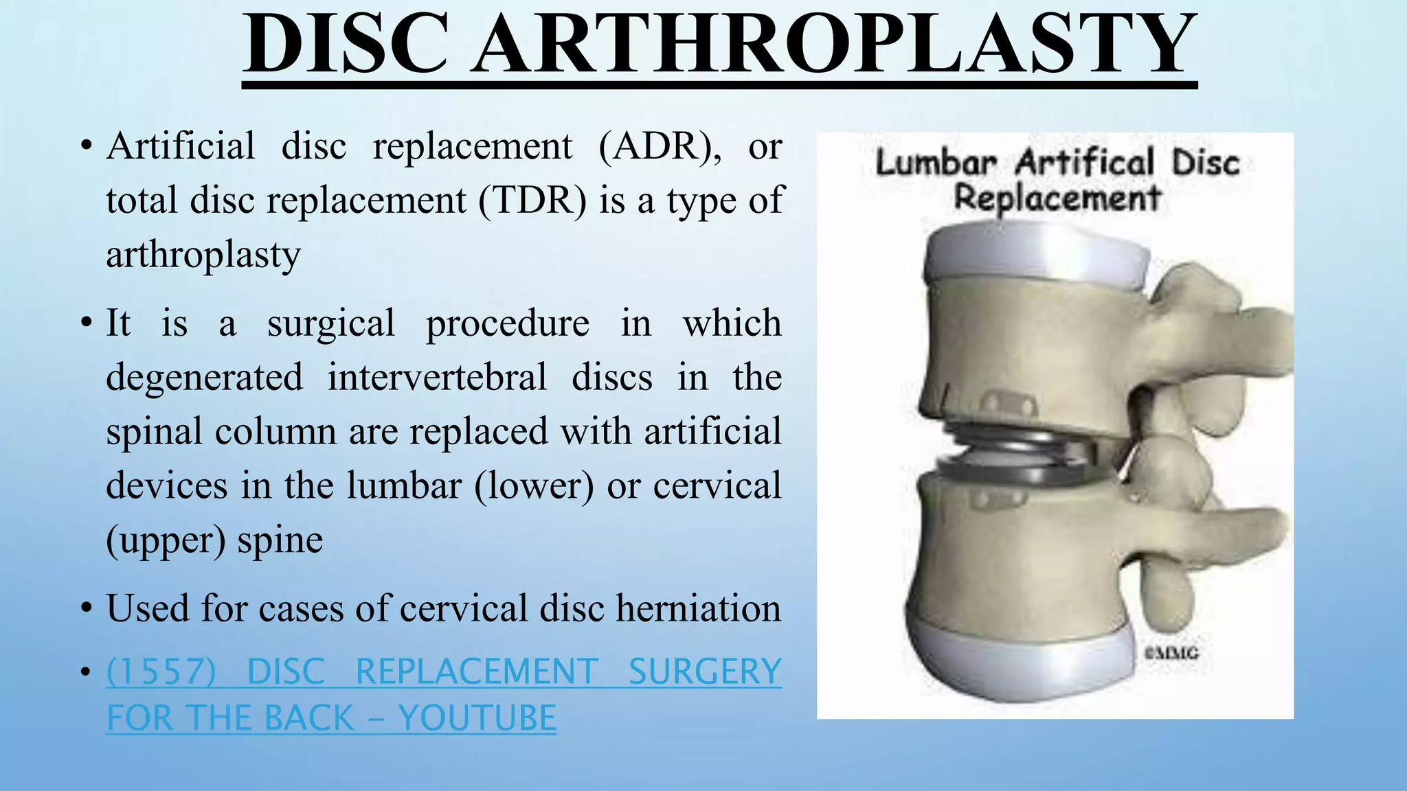 Prolapsed intervertebral disc ppt slideshare | PPTX