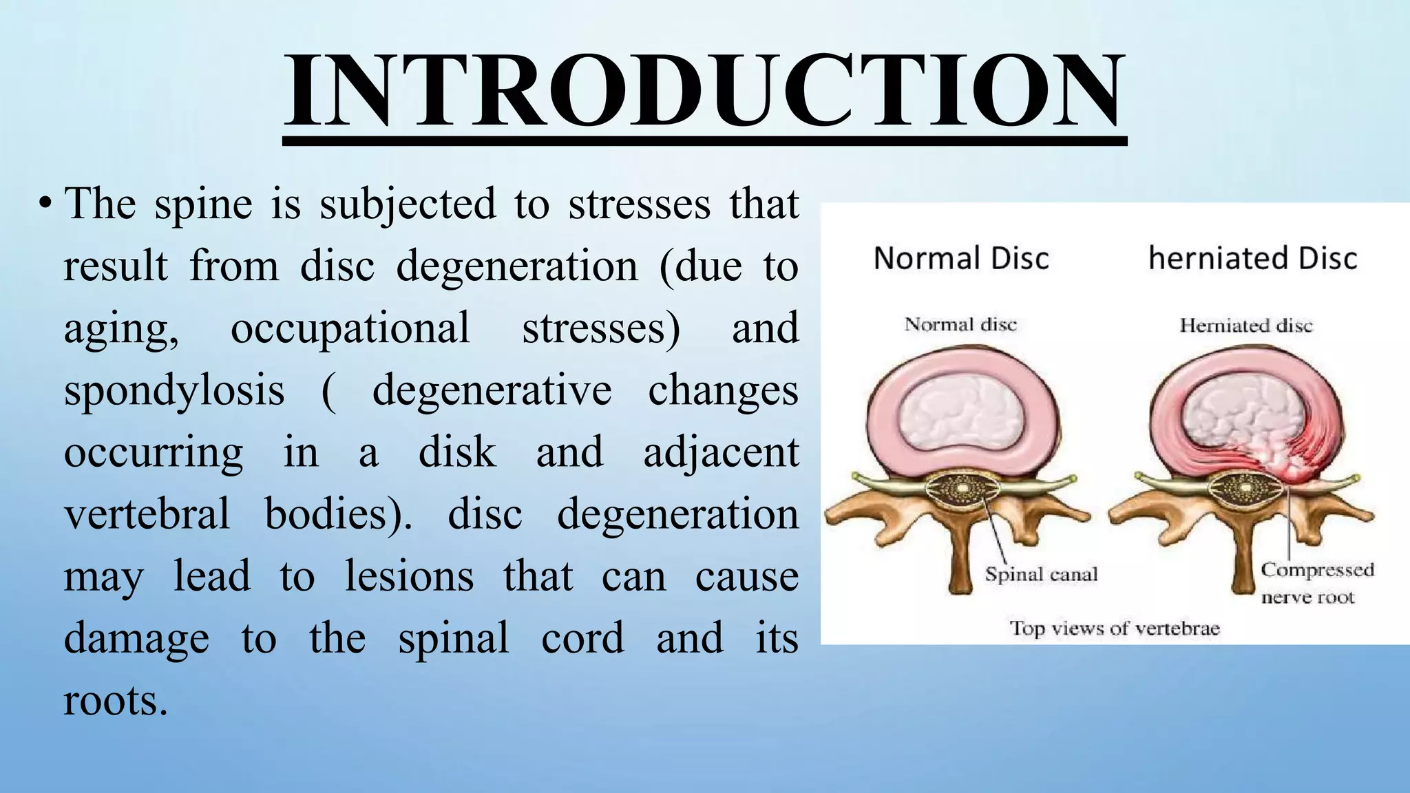 Prolapsed intervertebral disc ppt slideshare | PPTX