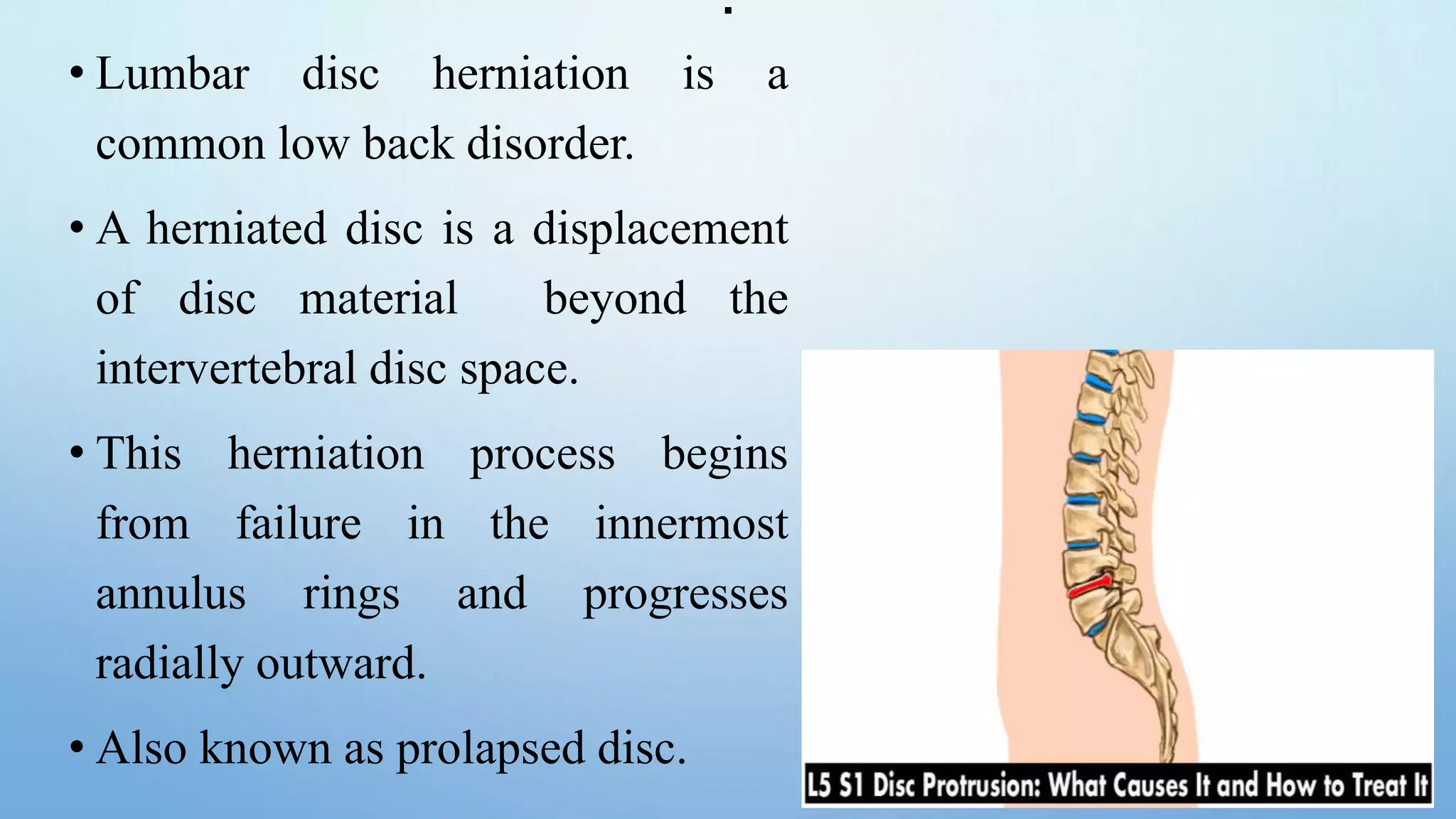 Prolapsed intervertebral disc ppt slideshare | PPTX