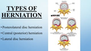 Prolapsed intervertebral disc ppt slideshare | PPTX