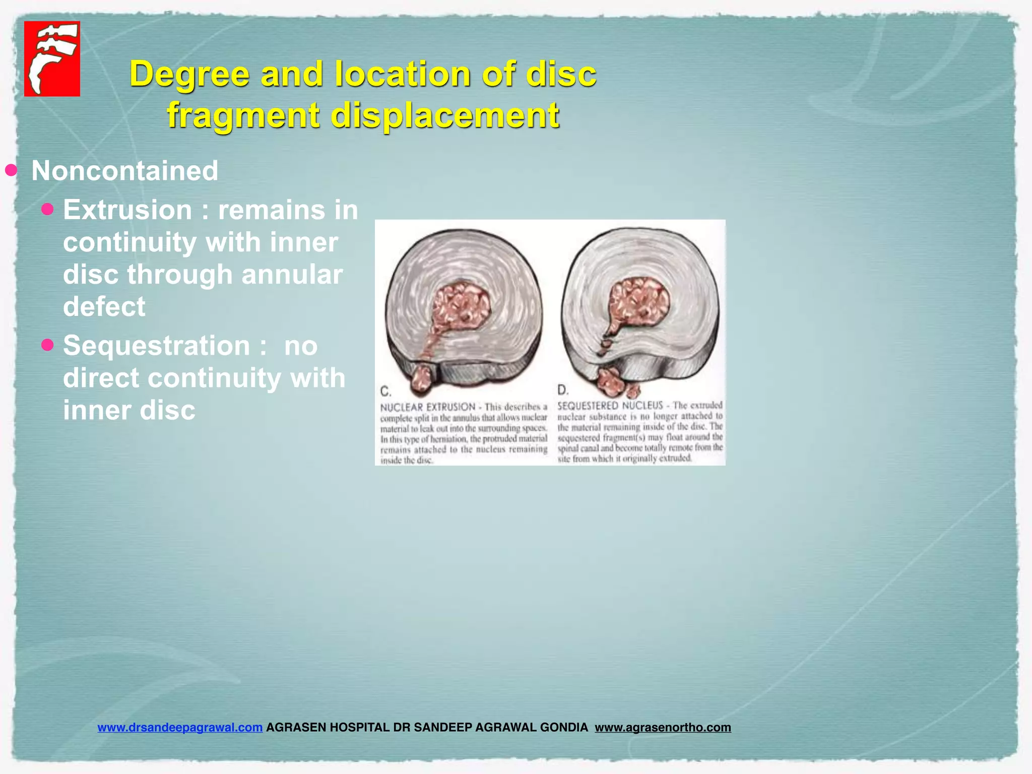PROLAPSE DISC (Slip Disc ) Herniation Intervertebral Disc AGRASEN ...