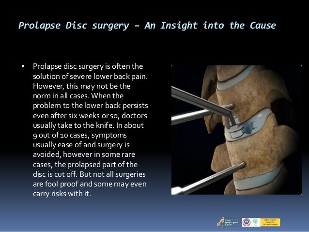 Prolapsed Disc