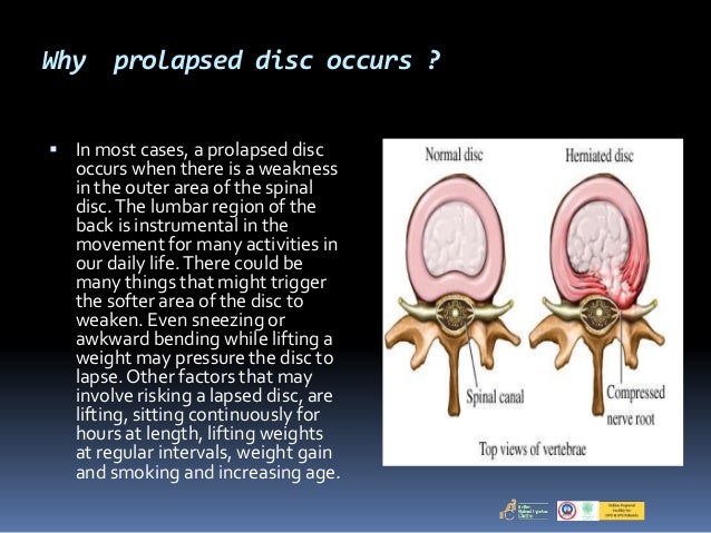 Prolapsed Disc Surgery