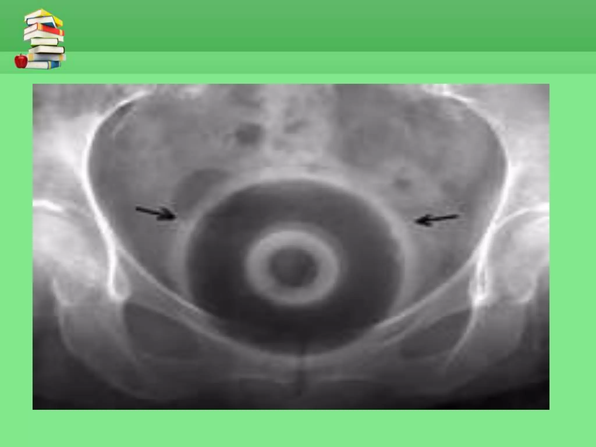 Prolapse management | PPTX