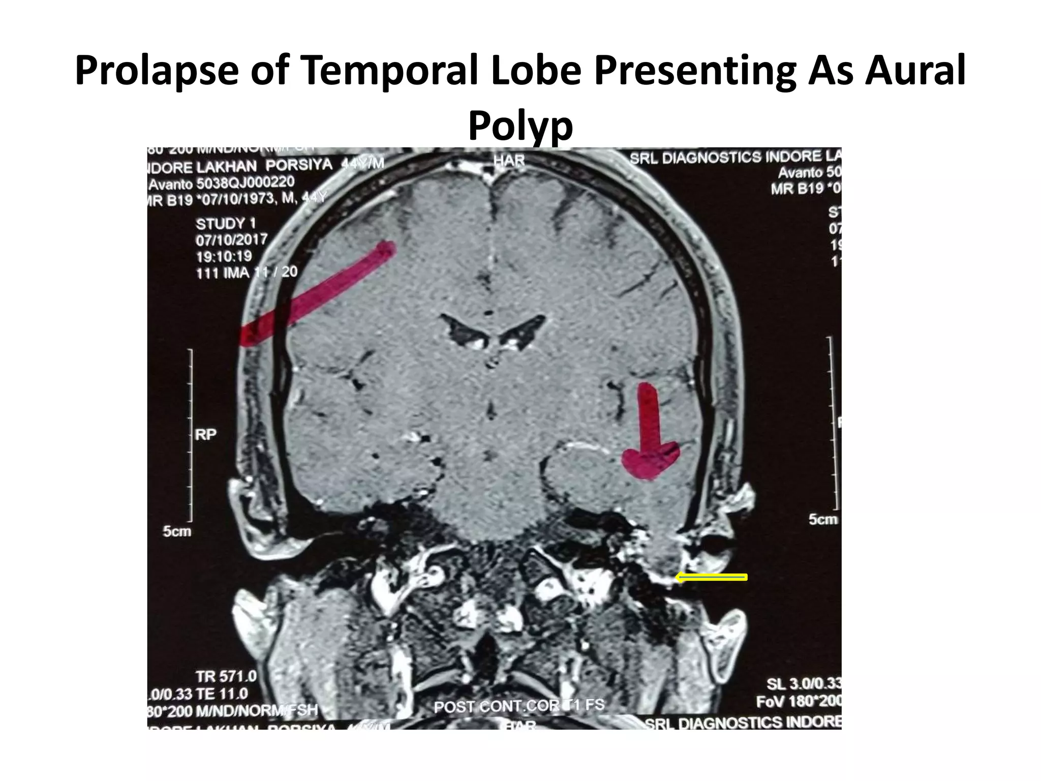 Prolapse of temporal lobe Presenting as Ear Polyp | PPT