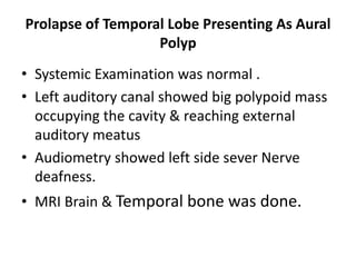 Prolapse of temporal lobe Presenting as Ear Polyp | PPT