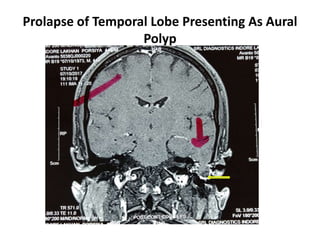 Prolapse of temporal lobe Presenting as Ear Polyp | PPT