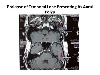 Prolapse of temporal lobe Presenting as Ear Polyp | PPT