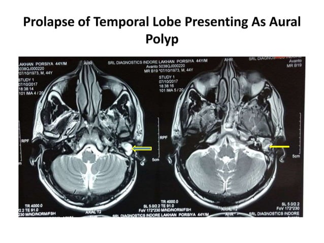 Prolapse of temporal lobe Presenting as Ear Polyp | PPT